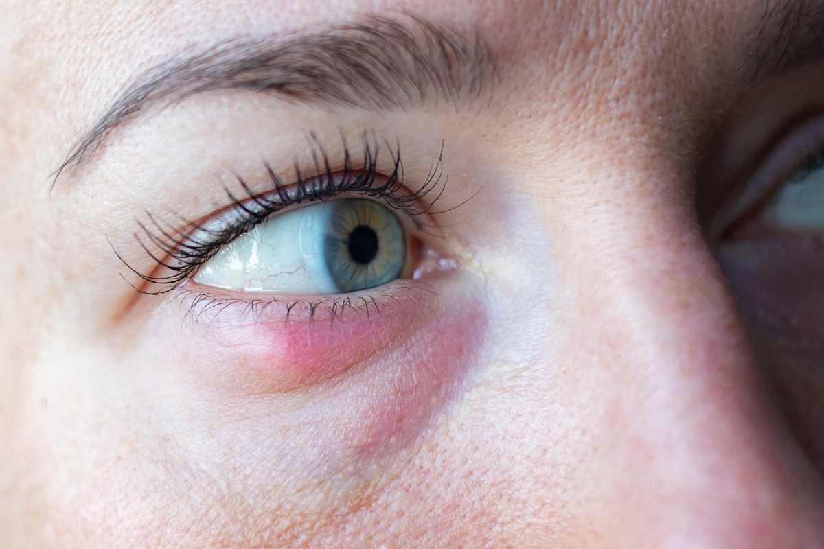 Jęczmień na oku - jak się go pozbyć skutecznie | Apteka zdrowie