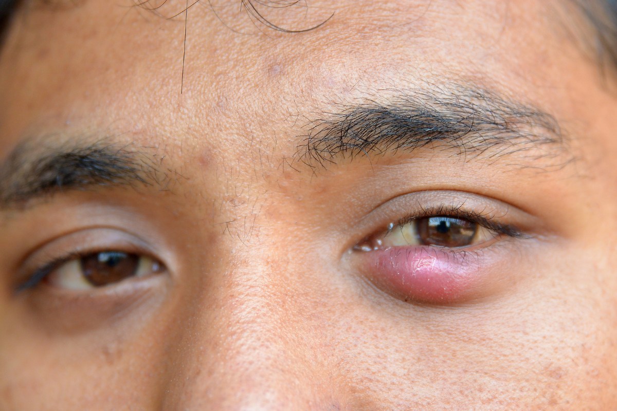 Jęczmień na oku - jak się go pozbyć skutecznie | Apteka zdrowie